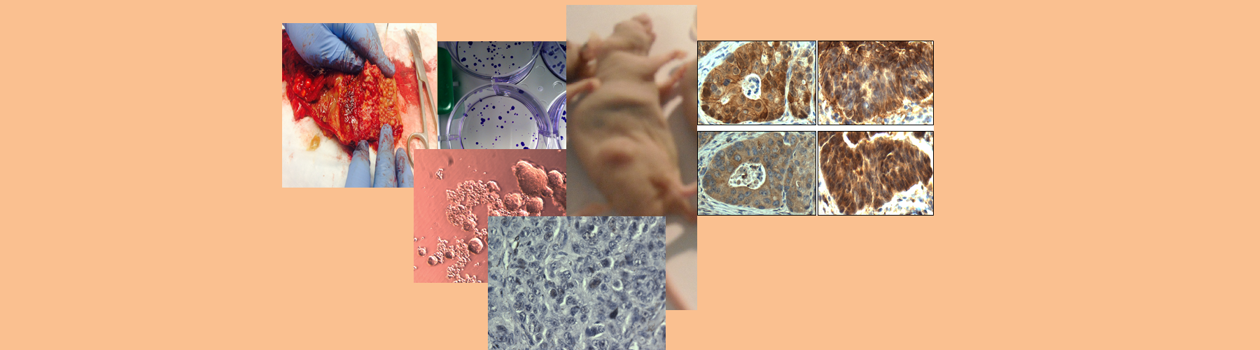 What Are The Symptoms Of Vascular Cancer at Gabriel Williamson blog