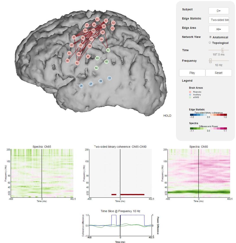 Investigating the Speech Network Using Electrocorticography | Guenther Lab